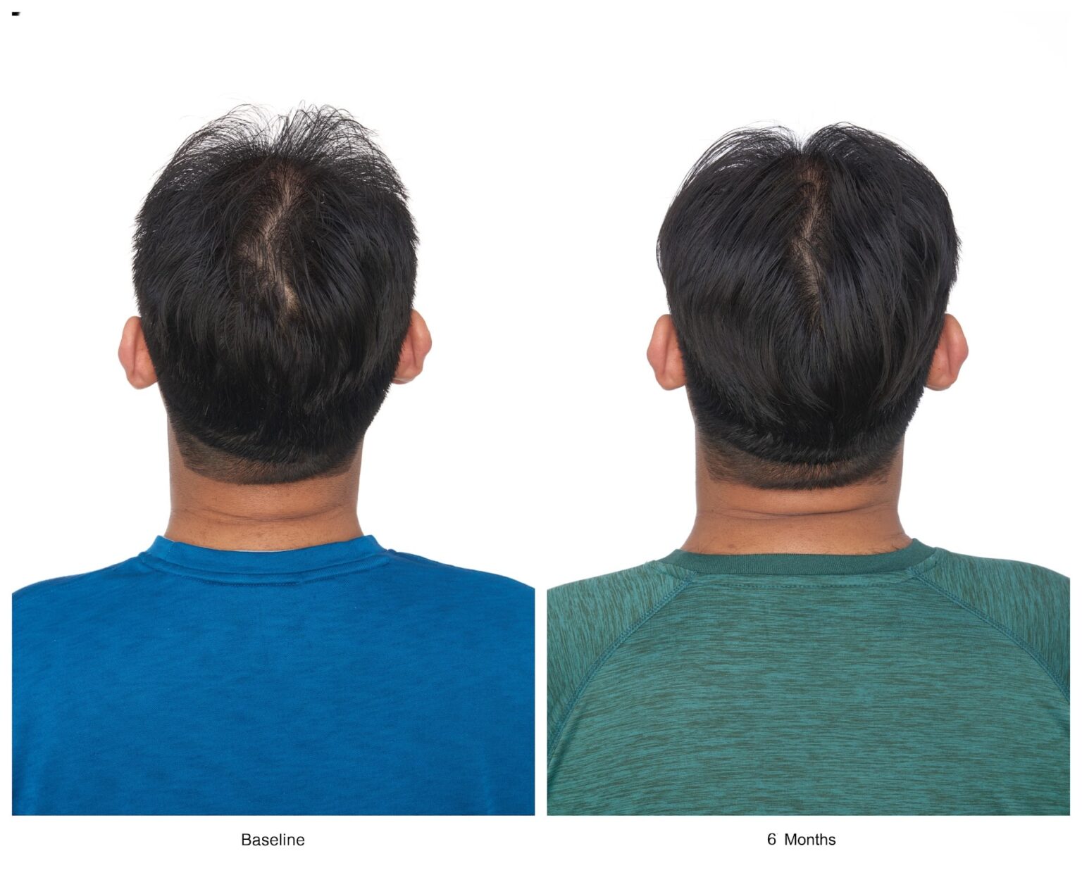 Minoxidil for Hair Growth: Timeline, Results & What to Expect