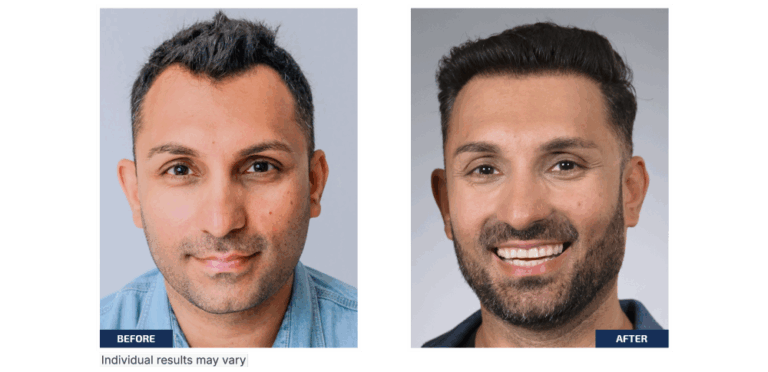 Hair Loss Treatments Compared: Which Is Best for You? | Bosley